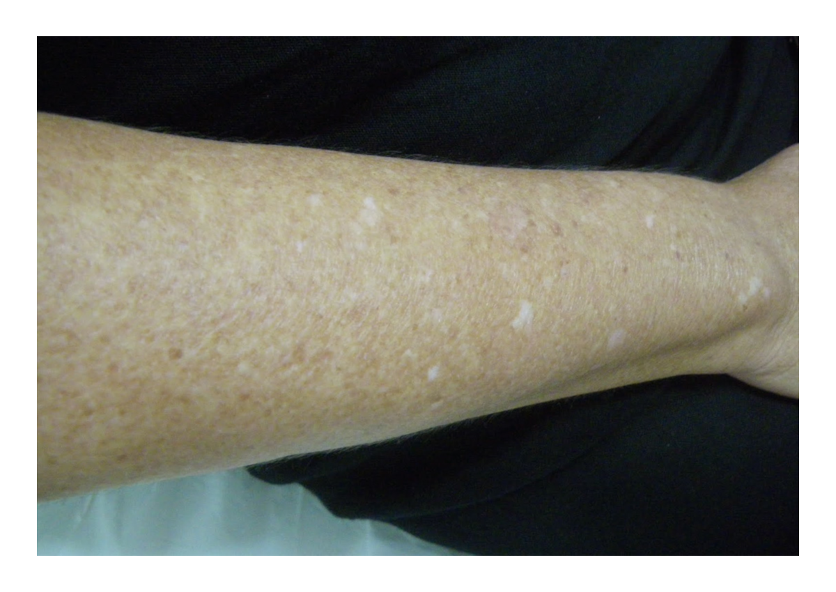 Diversità | Leucodermia Solar - Diversità Dermatologia